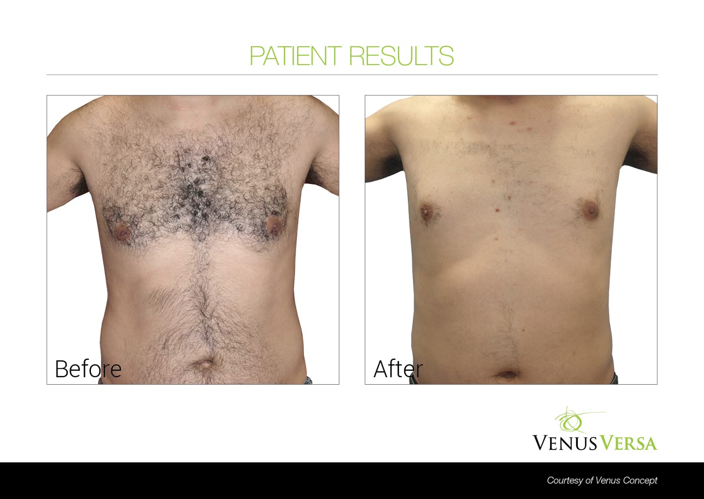 VVE_BeforeAftersHair5 - DaVinci Aesthetic & Regenerative Medicine
