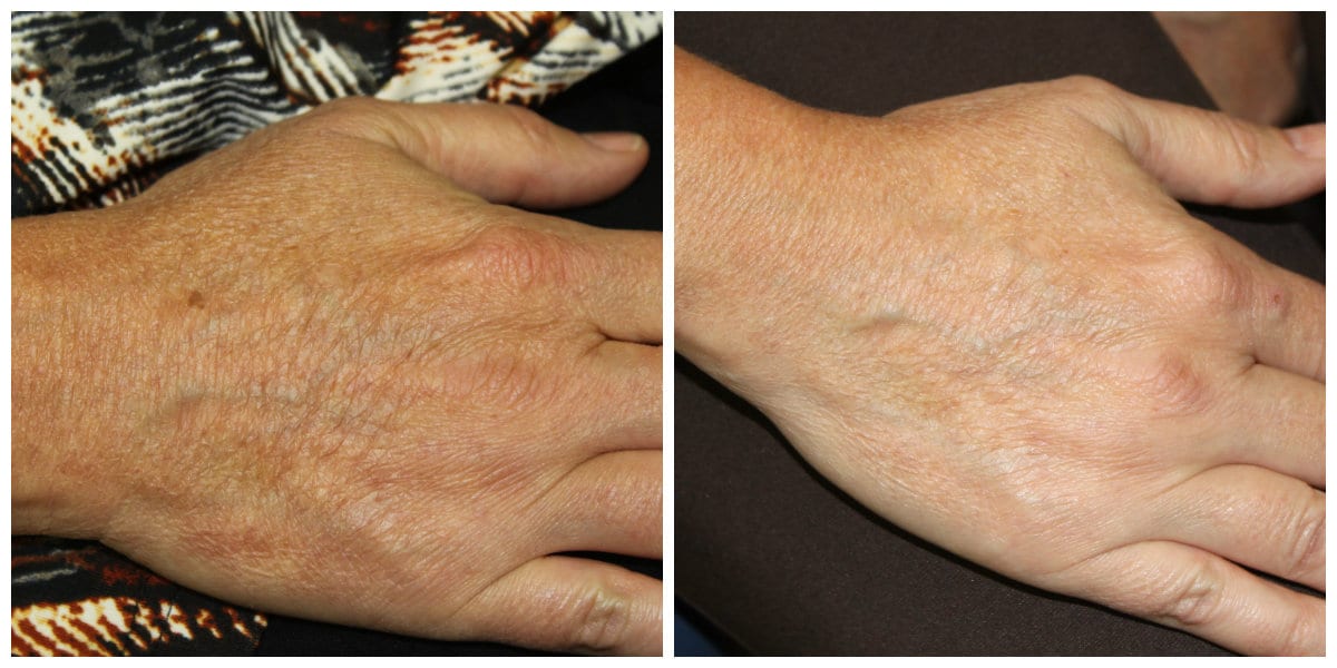 hand brown spotsgone better texture right - DaVinci Aesthetic ...