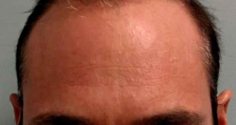 smooth-forehead-and-glabella - DaVinci Aesthetic & Regenerative Medicine
