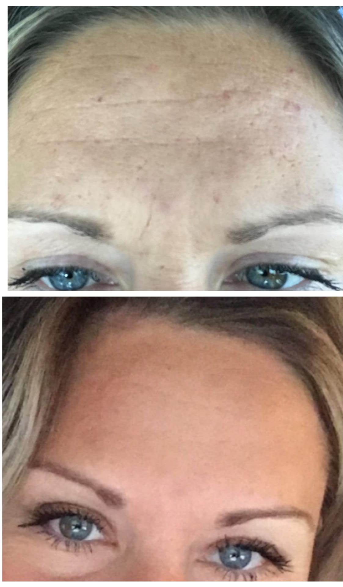 Botox Results - DaVinci Aesthetic & Regenerative Medicine